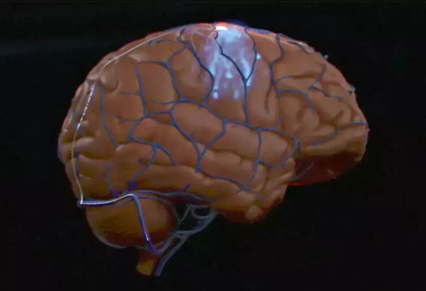 Synchron is the first to implant a human brain-computer interface in ...